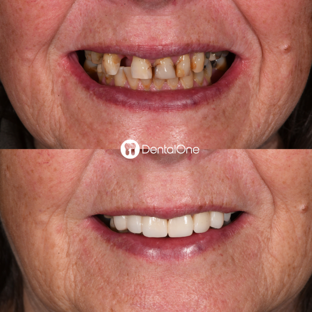 Chewing problems or missing teeth? - DentalOne