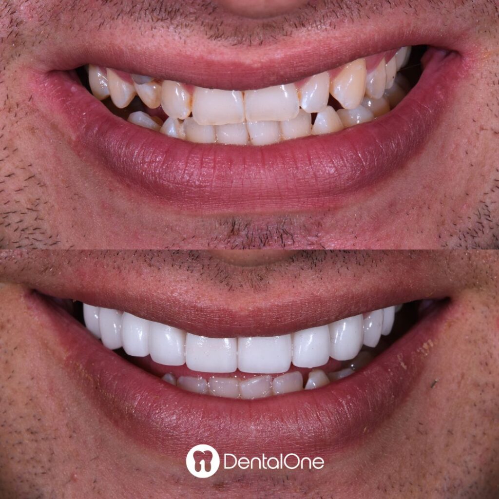 Chewing problems or missing teeth? - DentalOne