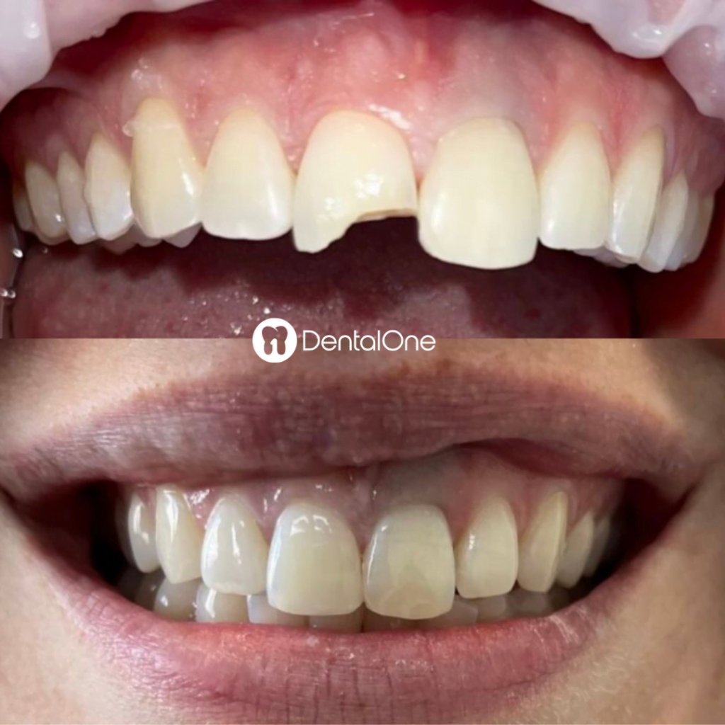 Chewing problems or missing teeth? - DentalOne